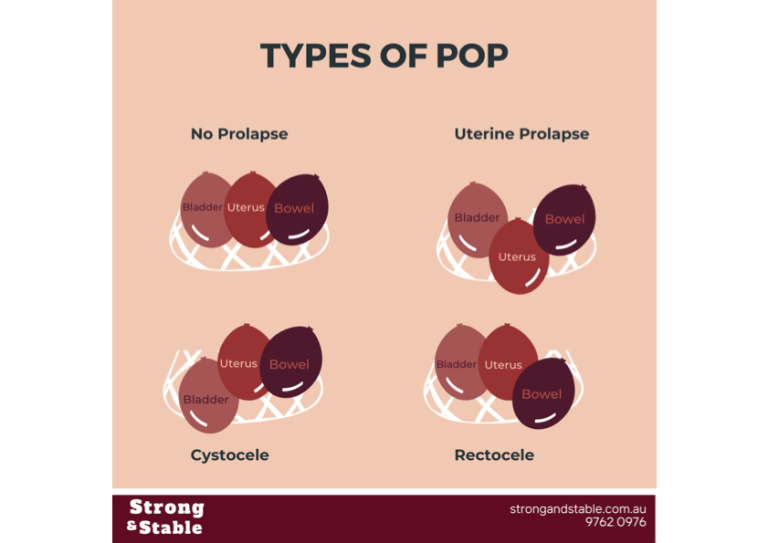 Strong and Stable | Exercise Management for Pelvic Organ Prolapse (POP)